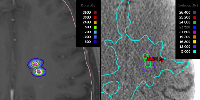 Study Reveals Differences in Radiation Exposure Across Platforms